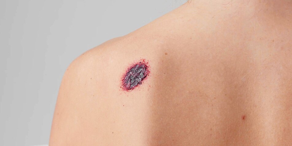 Luka Sayat: Pengertian, Penyebab, dan Perawatan