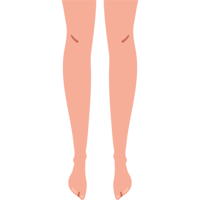 Stages of Lymphedema | JOBST