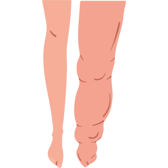 Stages of Lymphedema | JOBST UK