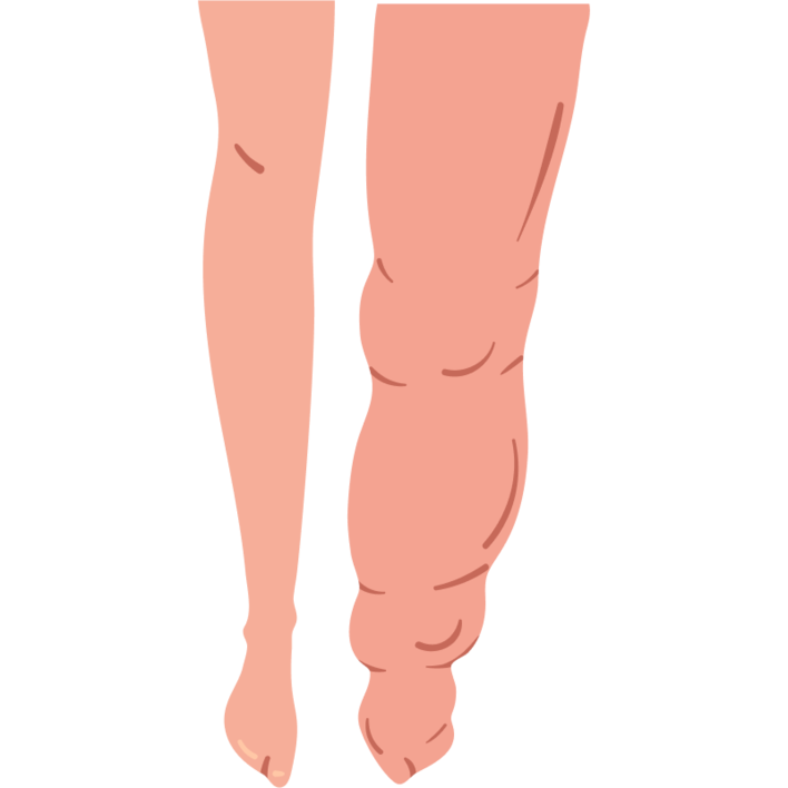 Stages of Lymphedema | JOBST UK