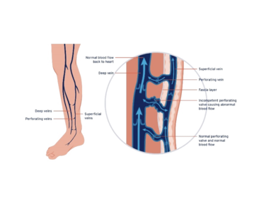 Ulcus cruris venosum – Symptome und Behandlung