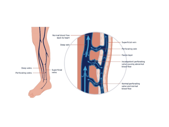 Chronic Venous Insufficiency – Clinical manifestations