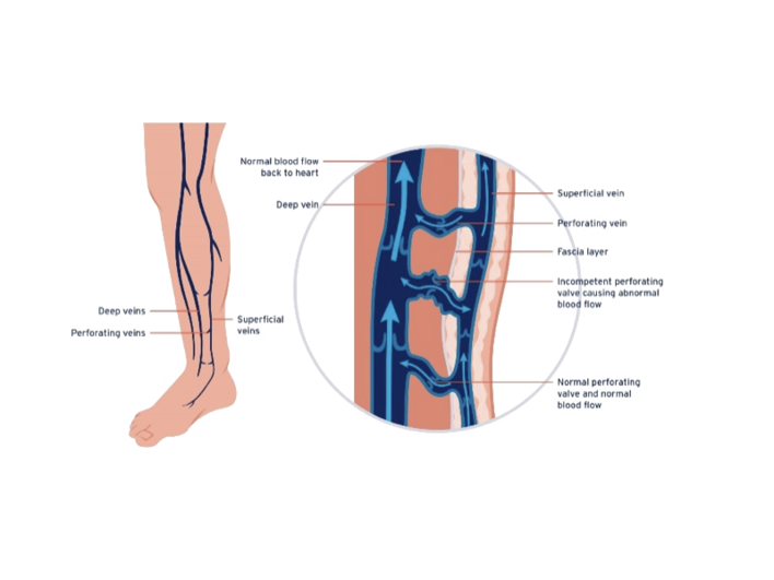 Chronic Venous Insufficiency – Clinical manifestations