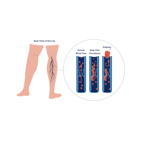 Thrombophlébite profonde : cause et prévention | JOBST