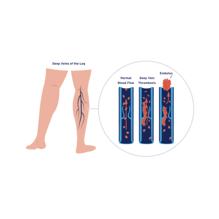 Deep vein thrombosis | JOBST UK