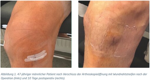 Atraumatischer Wundverschluss | Wundnahtstreifen & Hautkleber | Leukoplast