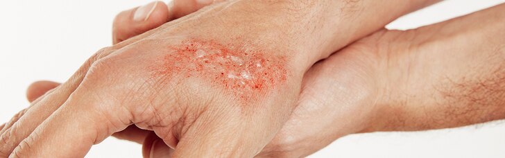 Wound care for burns: explore the Leukoplast options!