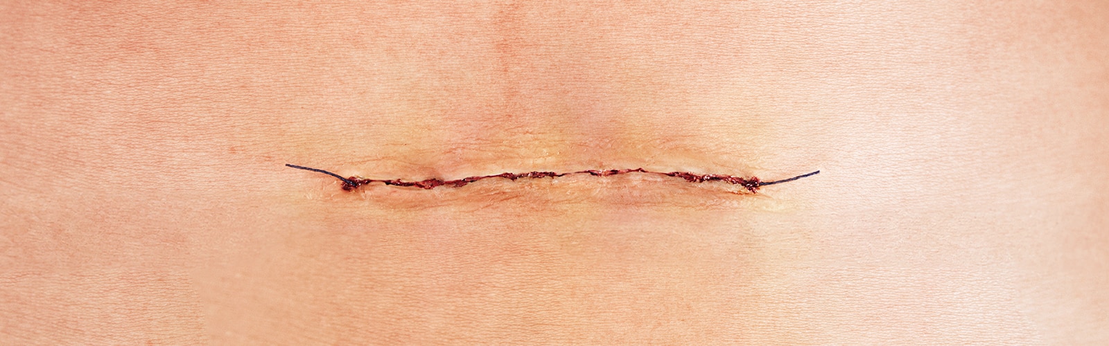 Wound care for surgical sites: explore the Leukoplast range!