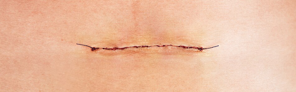 Wound care for surgical sites: explore the Leukoplast range!