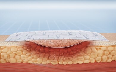 Cutimed® Sorbion® Border – atraumatic, self-adhesive, super-absorbent ...