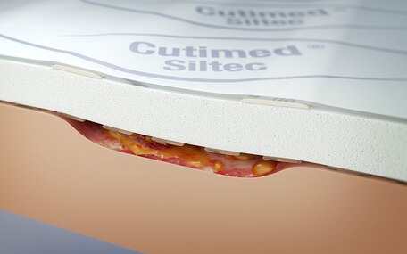 Cutimed®Siltec®B - Self-Adhesive Atraumatic Foam Dressing