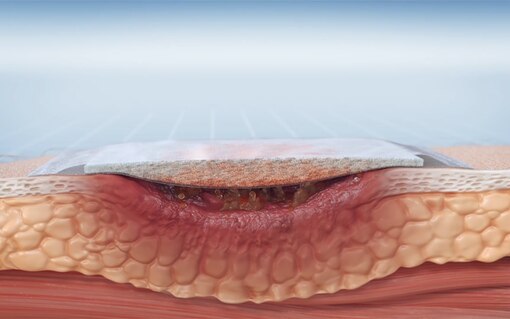 Cutimed®Sorbion® Sachet S—Superabsorbent Wound Dressing