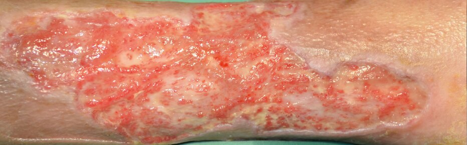 Ulcus cruris venosum: Infektions- und Exsudat-Management