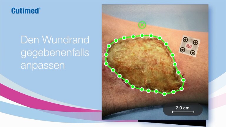 Wunddokumentation mit der Cutimed® Wound Navigator App