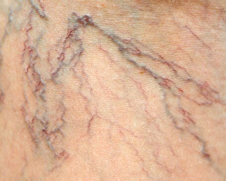 Telangiectasias: Hoe ze eruit zien en wat ze veroorzaakt