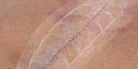 Operationswunden: Optimale Wundversorgung & Pflege nach OP