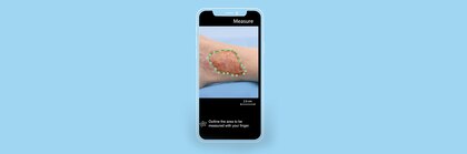Descubre qué es Cutimed Wound Navigator