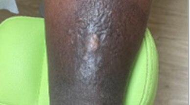 Skin infections and skin tone in wound healing | Leukoplast UK