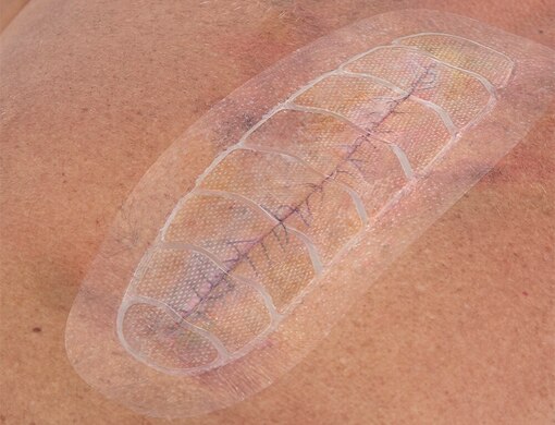 Operationswunden: Optimale Wundversorgung & Pflege nach OP