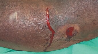 Skin Tears: Wundbeurteilung bei allen Hauttönen | LEUKOPLAST