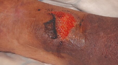 Skin Tears: Wundbeurteilung bei allen Hauttönen | LEUKOPLAST