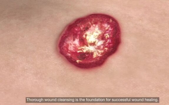 Cutimed DebriClean – For Wound Cleansing and Debridement