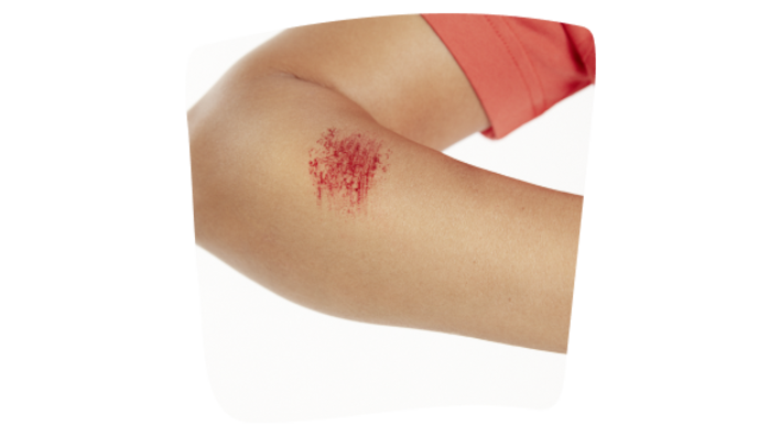 Quais são os 7 tipos de feridas | Leukoplast