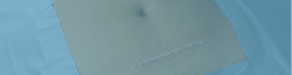 Infección en una herida quirúrgica: síntomas y cura - Leukoplast