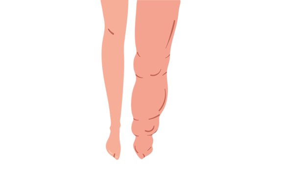 Stages of Lymphedema | JOBST USA