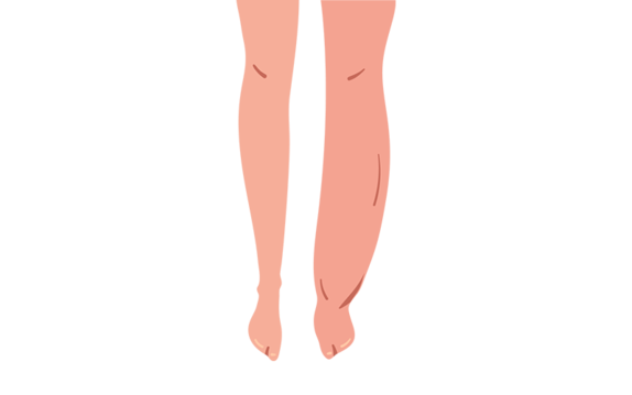 Stages of Lymphedema | JOBST USA
