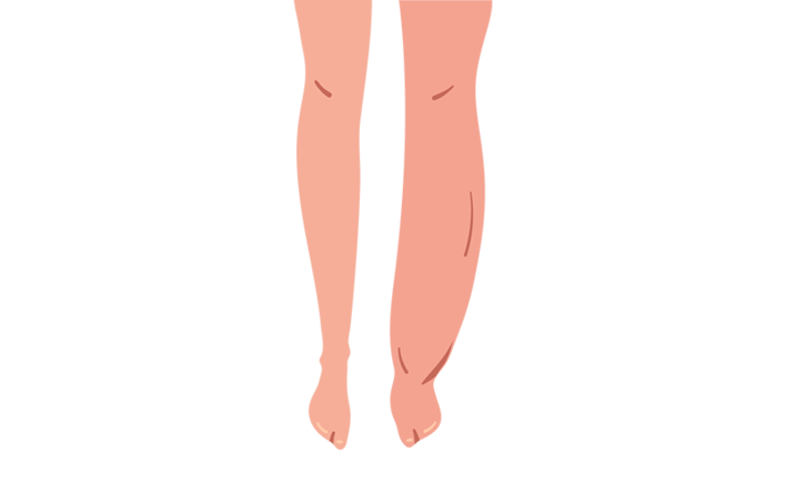 Stages of Lymphedema | JOBST USA
