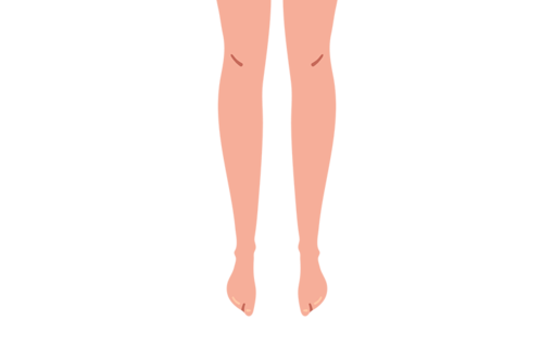 Stages of Lymphedema | JOBST USA