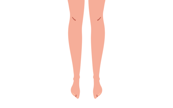 Stages of Lymphedema | JOBST USA
