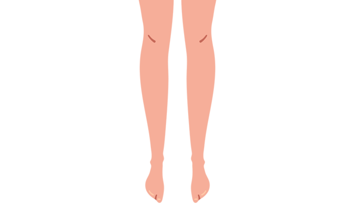 Stages of Lymphedema | JOBST USA