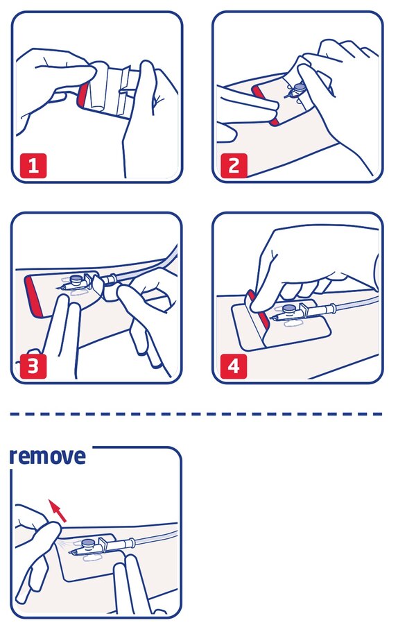 Leukomed IV film – IV dressing for intravenous injection sites